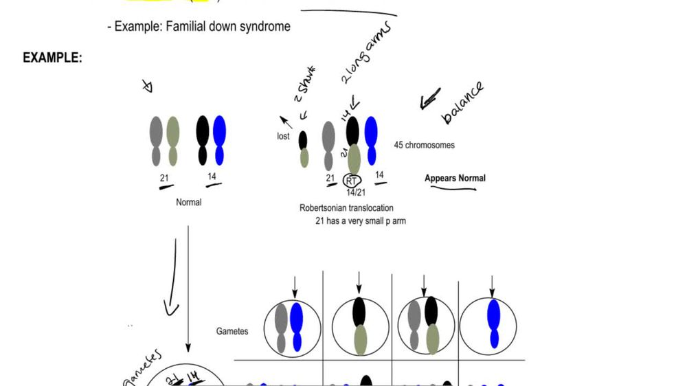 Robertsonian Translocation Balanced Vs Unbalanced